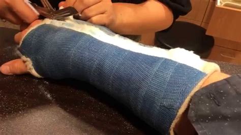 Dan's arm cast removal - YouTube