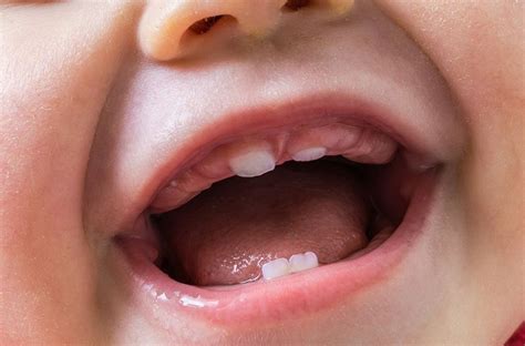 Прорезывание зубов у детей – Симптомы, порядок и сроки прорезывания ...