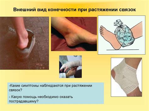 Первая помощь при растяжении связок, вывихах суставов, переломах костей ...