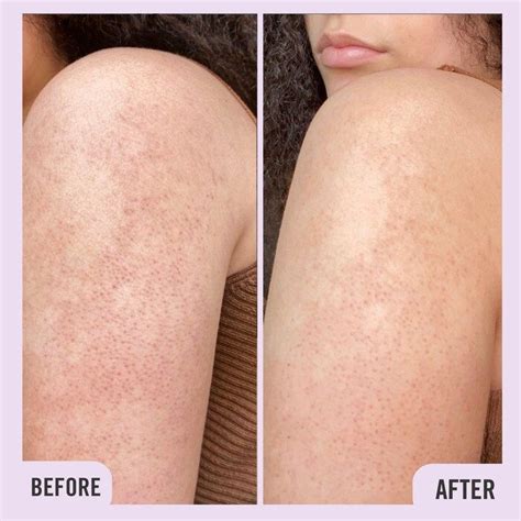 KP Bump Eraser Body Scrub with 10% AHA - First Aid Beauty | Sephora ...