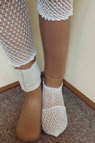 Elastic Tubular Band. Эластичный сетчатый трубчатый бинт на предплечье ...