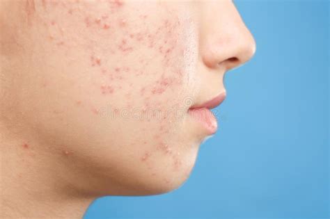 Teen Girl with Acne Problem Squeezing Pimple on Her Face Stock Photo - Image of face, hygiene ...