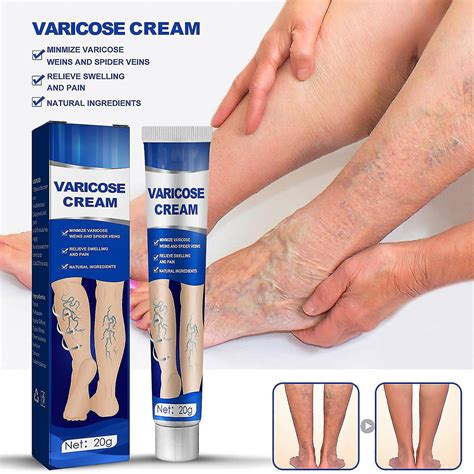 Varicose Veins Cream 20g Natural Plant Massage Cream For Varicose And ...