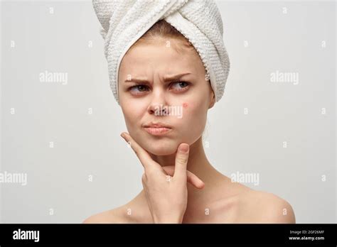 pretty woman with a pimple on the face dermatology isolated background Stock Photo - Alamy