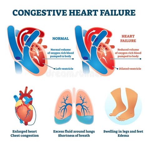Congestive Heart Failure Vector Illustration. Labeled Medical Compare ...