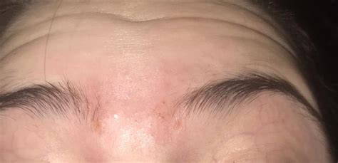 So many hard lumps between eyebrows that have pus in them? – General ...