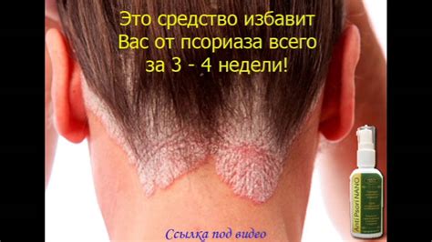 Псориаз на волосистой части головы: причины появления и симптомы ...