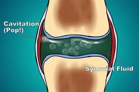 Popping Knee: Symptoms, Causes, Treatment By Knee Braces
