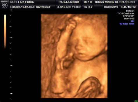 26 Weeks Ultrasound