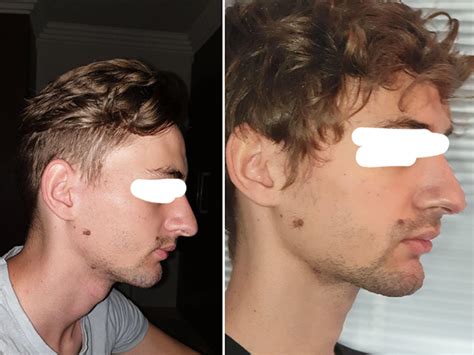 Mewing Before & After Results: 70+ Crazy Transformations