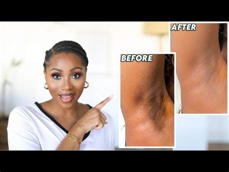 How i got rid of my dark underarms how to brighten your armpits keep them even smooth – Artofit