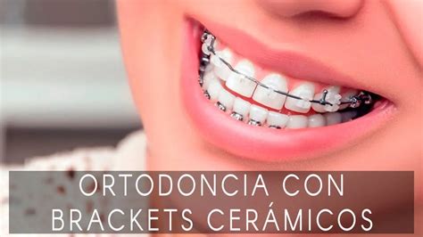 Cuidados De La Ortodoncia De Porcelana Para Una Sonrisa Perfecta | Ortodoncia Junin