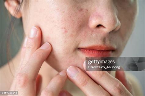 11,864 Women With Acne Stock Photos, High-Res Pictures, and Images ...