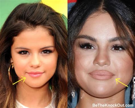 Selena Gomez Before And After Breast Implants