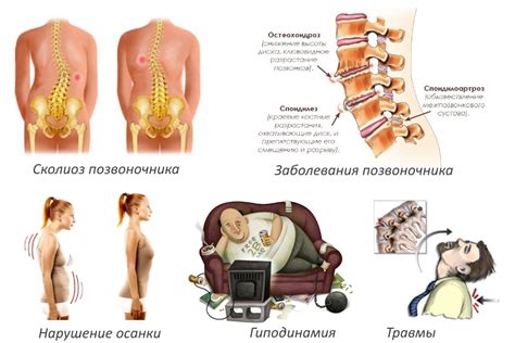 Протрузия дисков позвоночника: симптомы и лечение