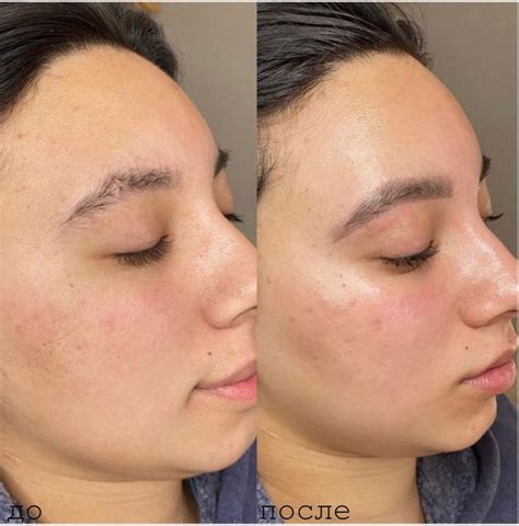 Обучение процедуре Dermaplaning - Дермапланинг: официальный сайт