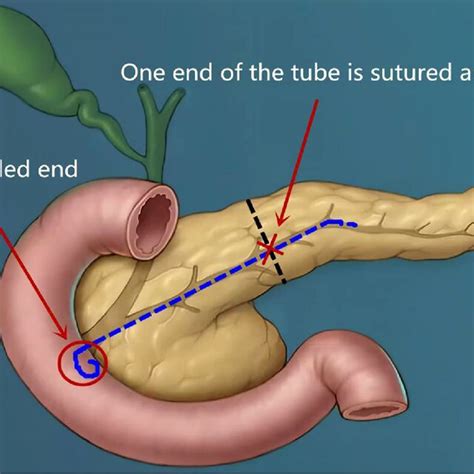 Laparoscopic central pancreatectomy (involving A, B, C, D four steps). | Download Scientific Diagram