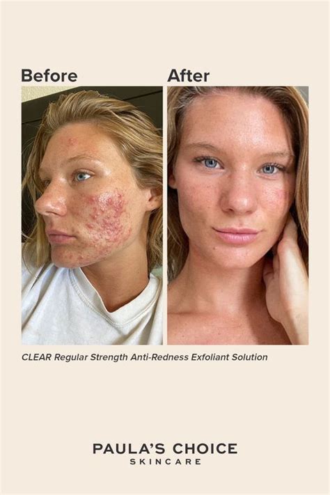 Paula's Choice Skincare (paulaschoice) | Official Pinterest account