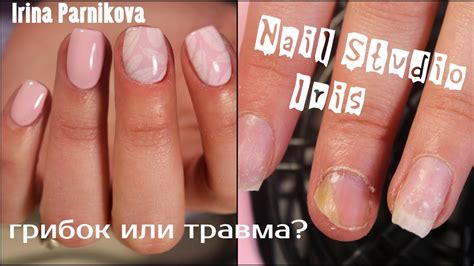 Маникюр на проблемных ногтях. Грибок или травма ногтя? - YouTube