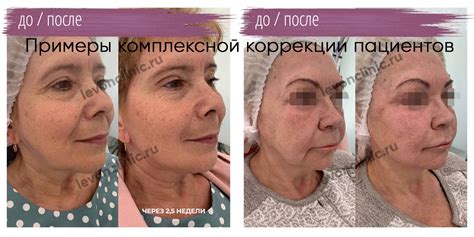 Брыли на лице: причины образования и способы коррекции