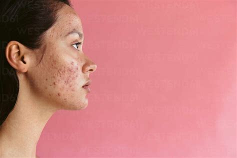 Side view portrait of a woman having acne inflammation. Close up of a ...