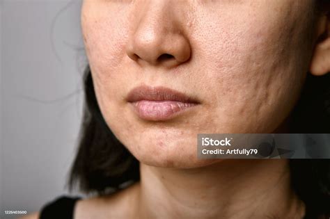 Skin Problem With Acne Diseases Close Up Woman Face With Dry Lip Mouth Scar And Oily Greasy Face ...