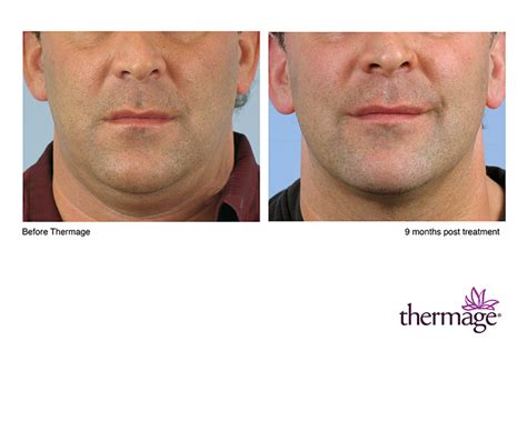 Thermage