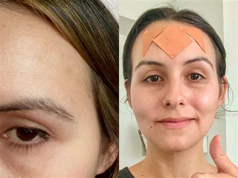 Botox Vs Face-Taping to Smooth Forehead Wrinkles - Business Insider