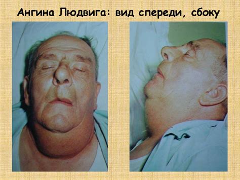 Атлас - стрептококковая инфекция - презентация онлайн