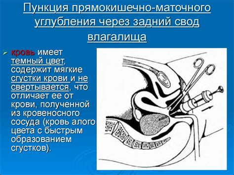 Дифференциальная диагностика острого аппендицита с гинекологической и ...