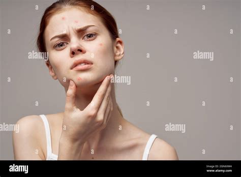 beautiful woman with pimples on the face hygiene isolated background Stock Photo - Alamy