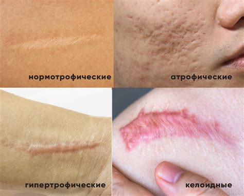 Методы лечения старых шрамов и рубцов - преимущества и недостатки ...