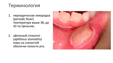 Синдром Маршалла - презентация онлайн