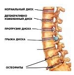 Радикулит – виды, симптомы, лечение, причины, диагностика
