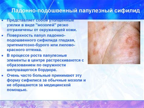 Сифилис - презентация онлайн