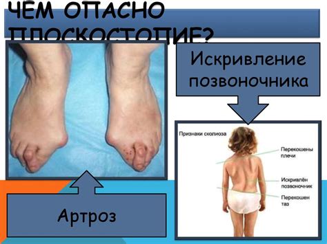 Возрастные особенности стопы ребенка (плоскостопие у детей ...