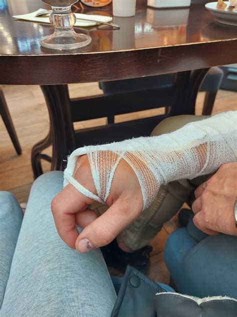 Опухла рука после наложения гипса - Вопрос хирургу - 03 Онлайн
