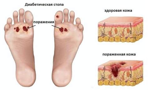 Диабетическая стопа: симптомы, причины, диагностика и лечение в лучших ...
