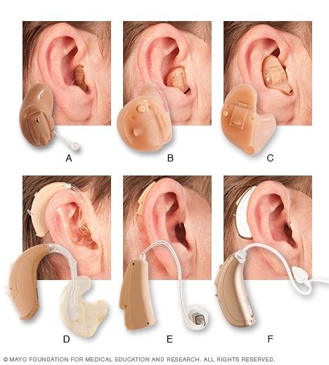 Hearing aid styles - Mayo Clinic