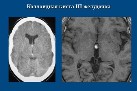 Коллоидная киста III желудочка: причины, симптомы, диагностика и лечение
