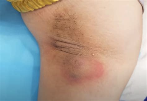 Draining Abscess Under Arm - New Pimple Popping Videos
