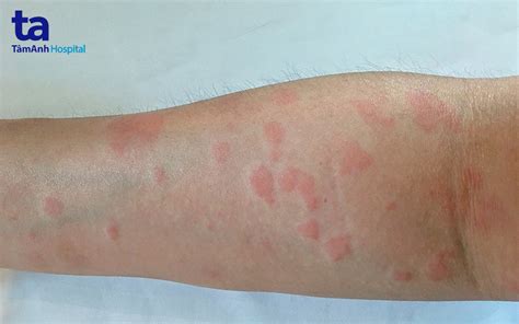 Lupus Ban Do La Benh Gi Online | emergencydentistry.com