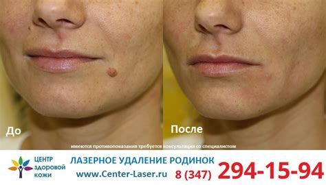 Лазерное удаление родинки на лице - Быстро, безопасно, без боли